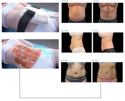 Supersculpt Non Invasive Body Sculpting - NJ Aesthetic Skin Clinic